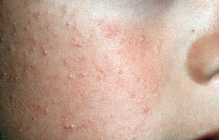 KERATOSIS PILARIS- "Chicken skin" - Stamford Skin Centre
