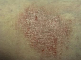 LICHEN SIMPLEX CHRONICUS- NEURODERMATITIS