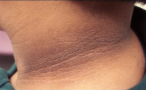 ACANTHOSIS NIGRICANS -" Dark neck"