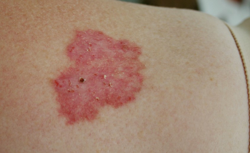 SKIN CANCER- BASAL CELL CARCINOMA