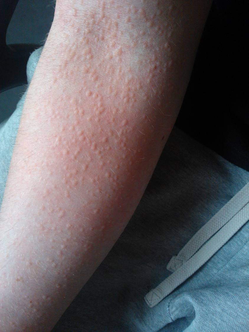URTICARIA: CLASSIFICATION AND CAUSES