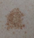 NEVUS SPILUS- SPECKLED LENTIGINOUS NEVUS