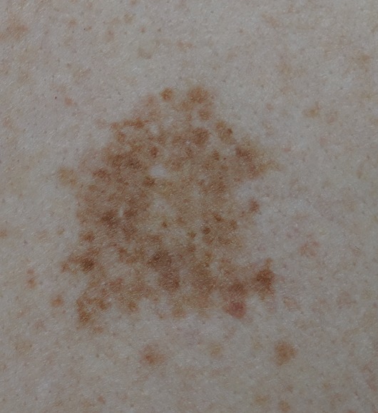 NEVUS SPILUS- SPECKLED LENTIGINOUS NEVUS