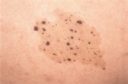 NEVUS SPILUS- SPECKLED LENTIGINOUS NEVUS