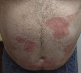 PARAPSORIASIS - Stamford Skin Centre