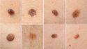 WHEN YOUR CHILD'S MOLE NEEDS TO BE CHECKED? - Stamford Skin Centre