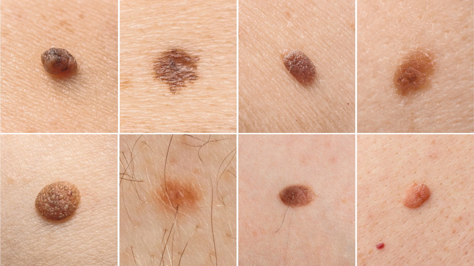 WHEN YOUR CHILD'S MOLE NEEDS TO BE CHECKED? - Stamford Skin Centre