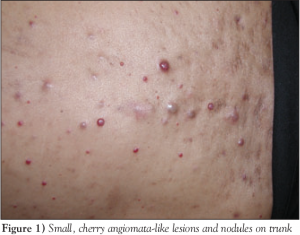 BACILLARY ANGIOMATOSIS - Stamford Skin Centre