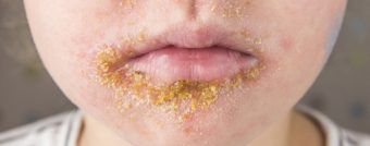 Impetigo, toxin-mediated disease, and ecthyma - Stamford Skin Centre
