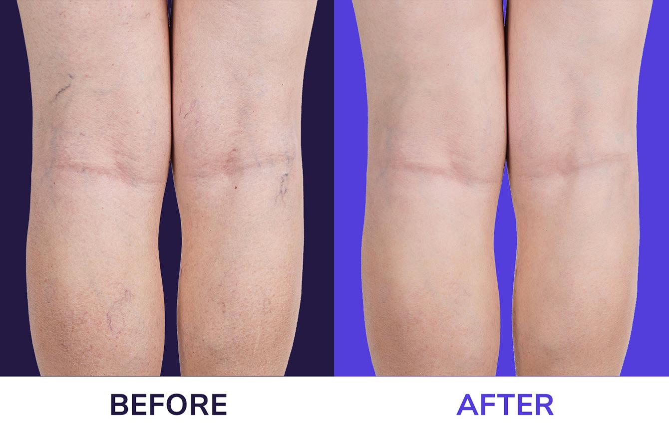 Varicose Vein Varicose Vein