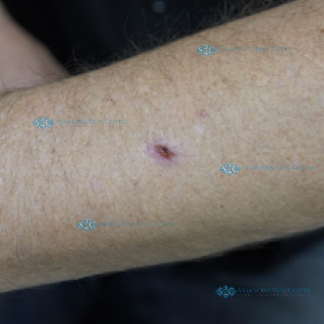 Long Lasting Nodule On The Skin Stamford Skin Centre