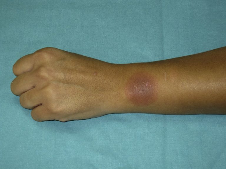 Drug-induced blisters or mucocutaneous ulcers - Stamford Skin Centre