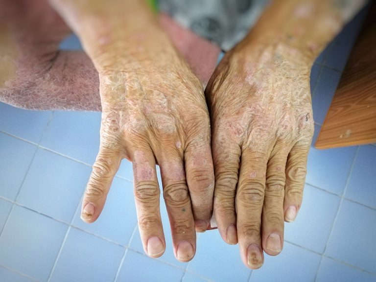 Diabetes and the skin - Stamford Skin Centre