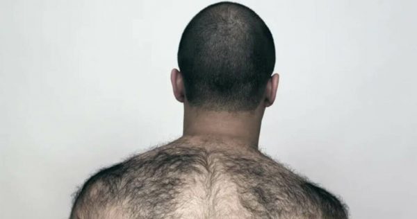 Hirsutism and hypertrichosis - Stamford Skin Centre