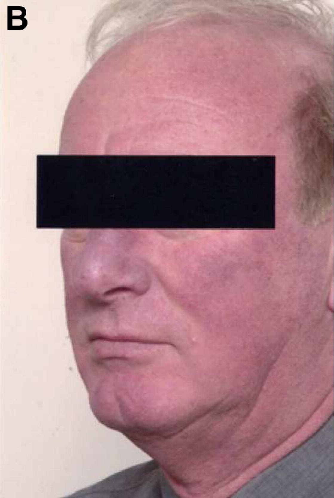 Carcinoid syndrome - Stamford Skin Centre